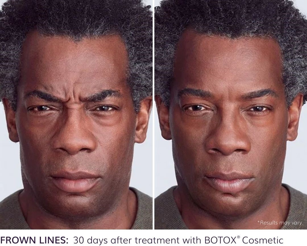 Botox | Buy Botox Online | ACRE Pharmacy