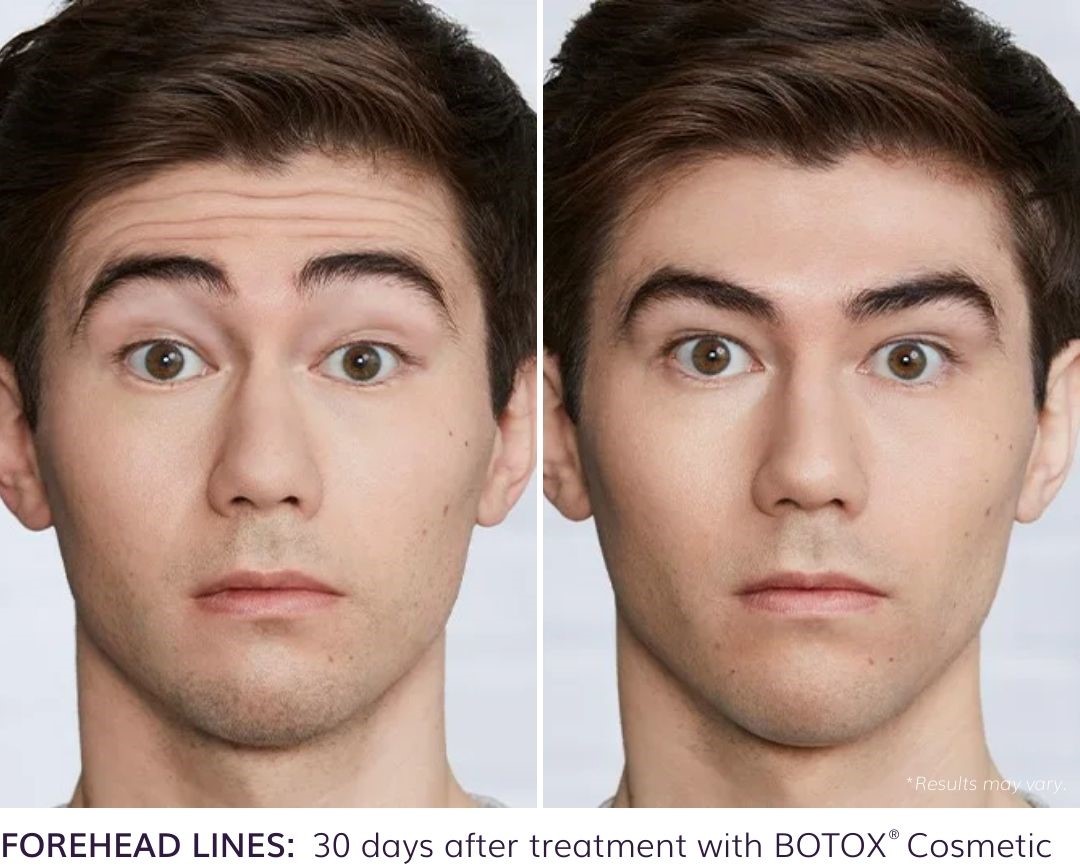 Botox | Buy Botox Online | ACRE Pharmacy