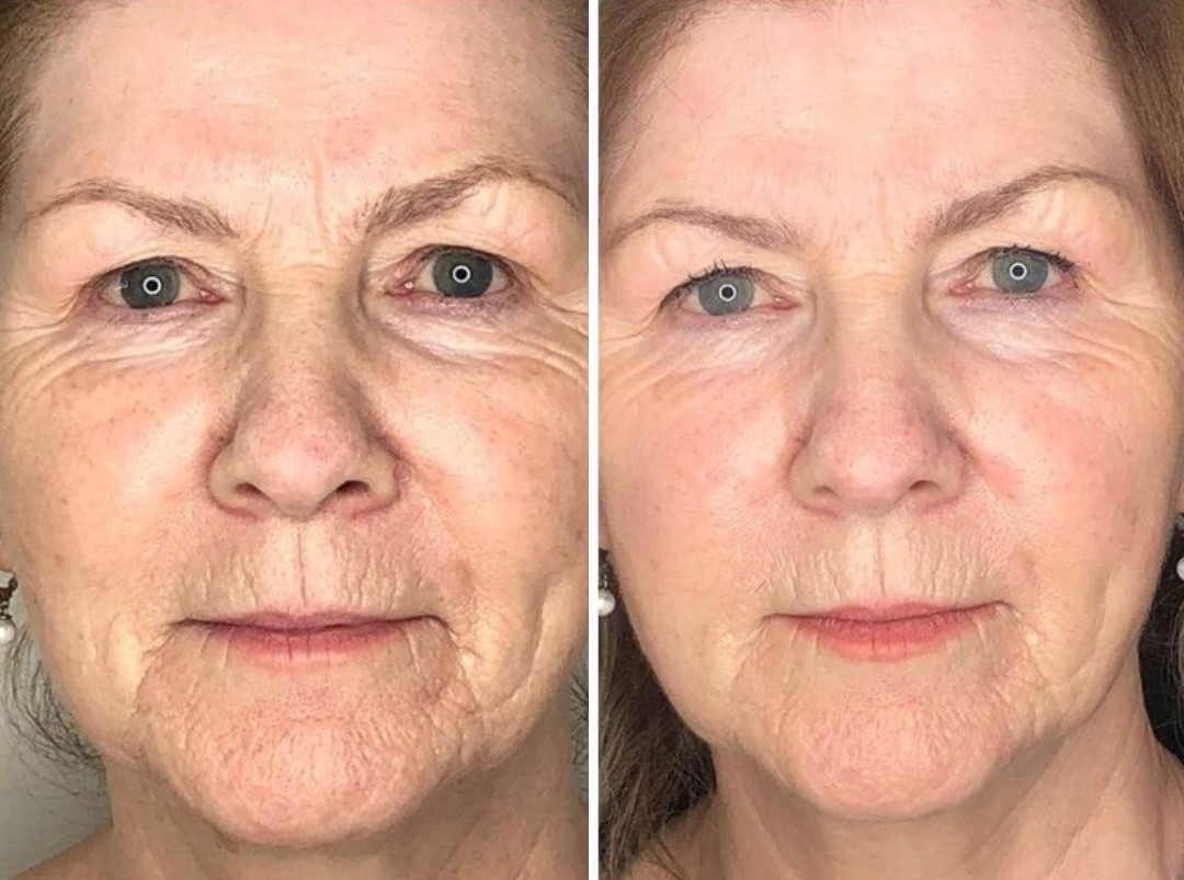 Profhilo | Buy Profhilo | ACRE Pharmacy