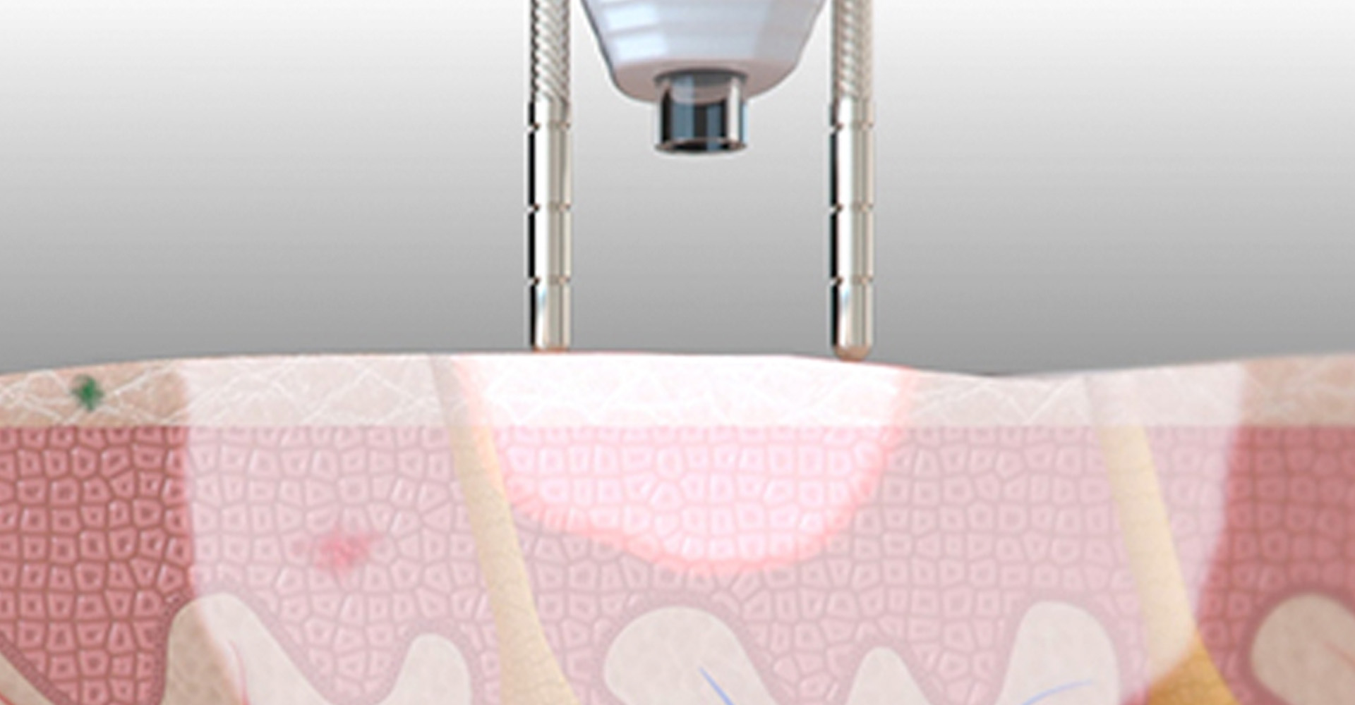 PlaDuo Dual Plasma System | ACRE Pharmacy