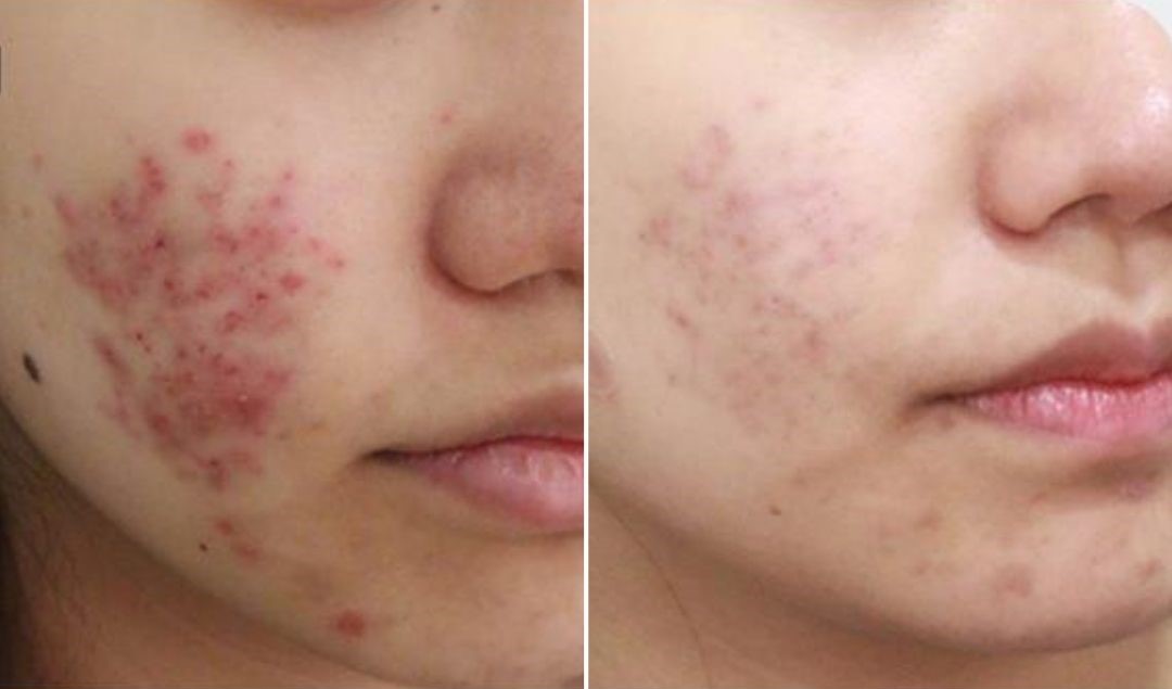 PlaDuo Dual Plasma System | ACRE Pharmacy