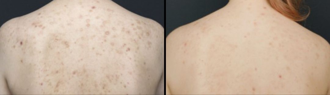 PlaDuo Dual Plasma System | ACRE Pharmacy