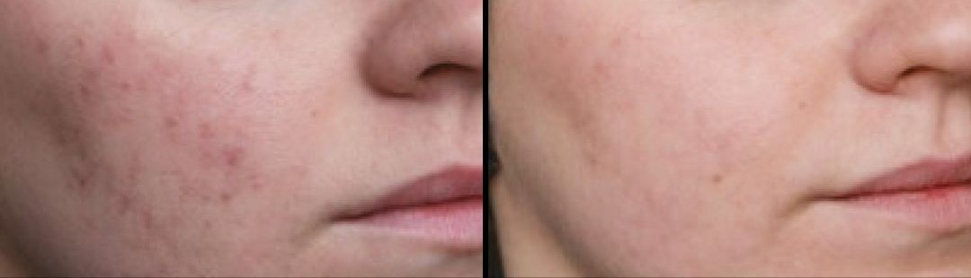 PlaDuo Dual Plasma System | ACRE Pharmacy