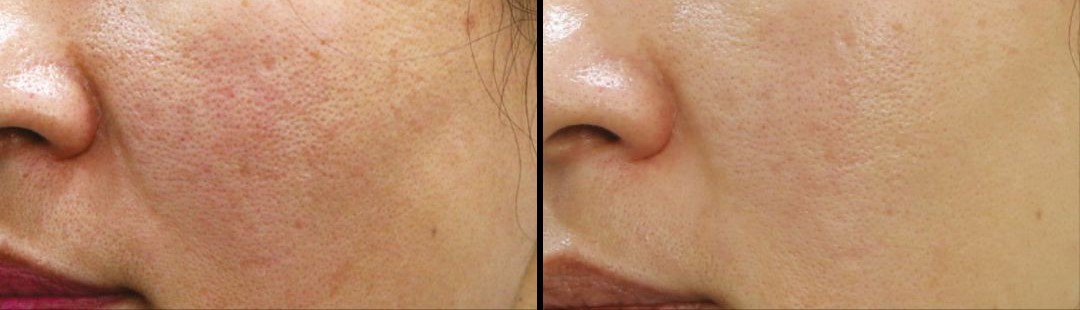 PlaDuo Dual Plasma System | ACRE Pharmacy