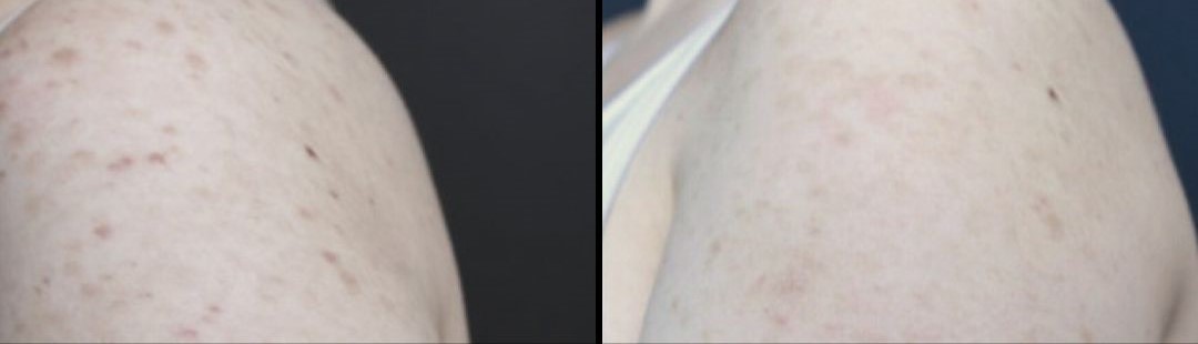 PlaDuo Dual Plasma System | ACRE Pharmacy