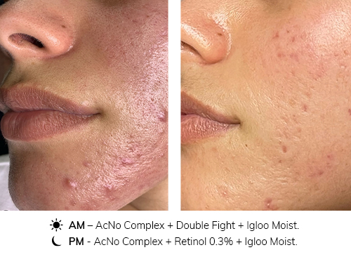 Acne: What It Is & How to Treat | NOON Aesthetics