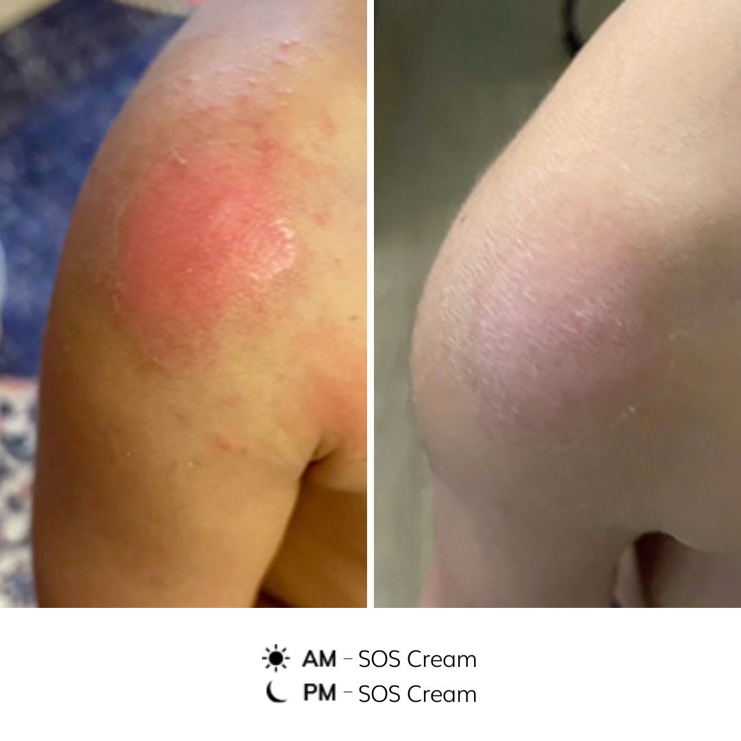 SOS Cream 50ml | ACRE