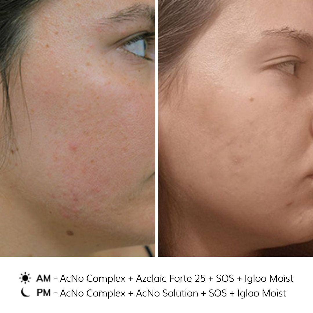 Product: Noon AcNO Solution 30g - [STOCK ITEM - VAT Payable]