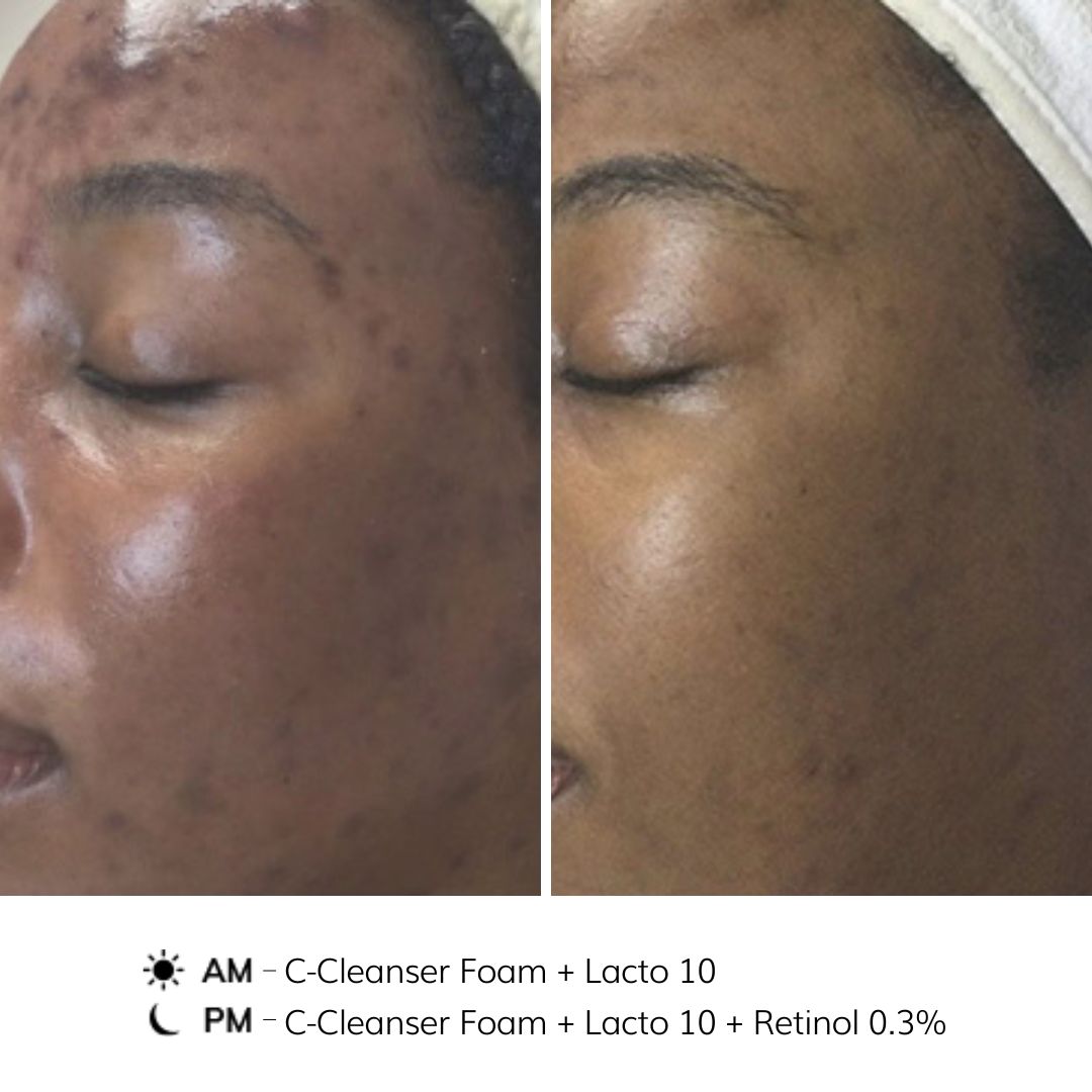 NOON Aesthetics For Pigmentation | ACRE Pharmacy