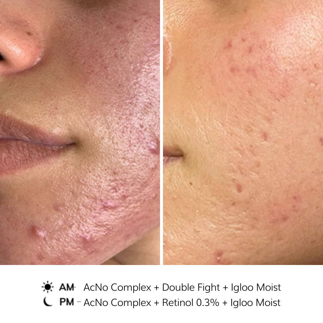 AcNo Complex (3 x 5ml) | ACRE