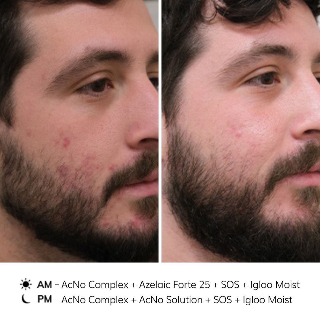 AcNo Complex (3 x 5ml) | ACRE