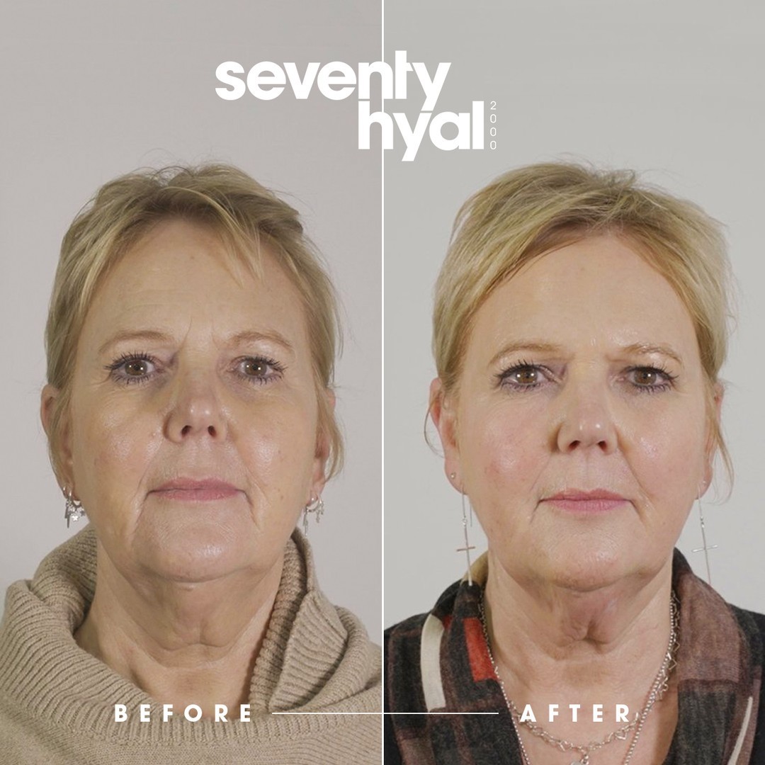 Seventy Hyal 2000 (3 x 2ml) With Needles | ACRE