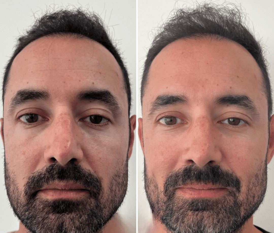 DermaFocus | Buy DermaFocus Polynucleotides | ACRE Pharmacy